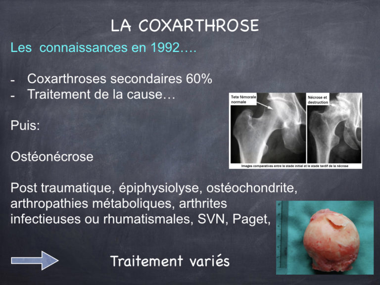 Arthrose de hanche - Dr Yves ROUXEL